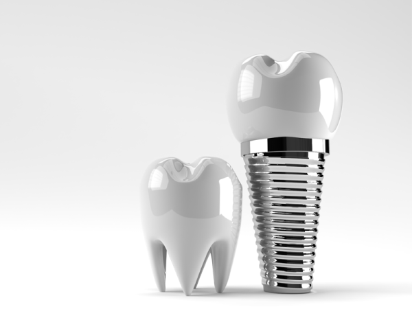 FaurDent - Clinica Stomatologică, Implanturi dentare